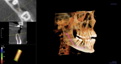 Periodontal (Gum) Evaluation And Diagnosis | Independence, MO ...